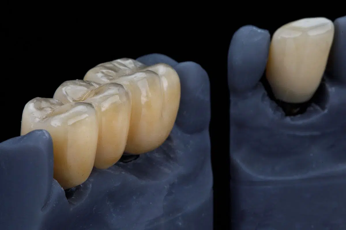 What to Do If Your Dental Crown Breaks | Borengasser Family Dental